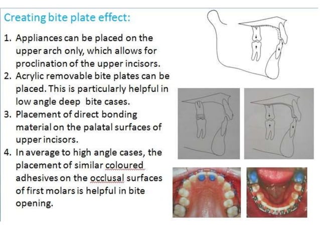 Arch leveling & overbite control | PPTX | Dental Health | Diseases and ...