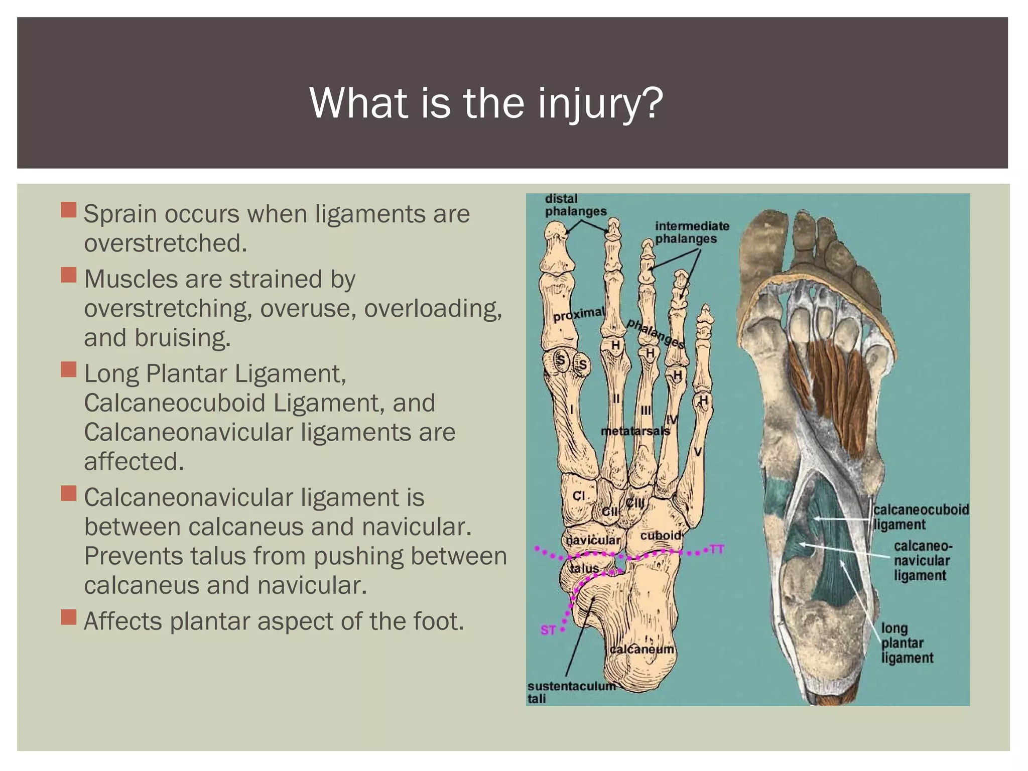 Arch sprains | PPT