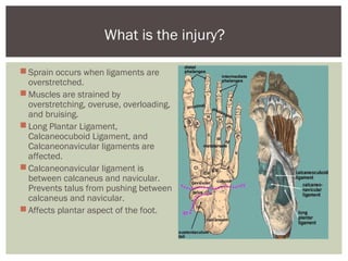 Arch sprains | PPT