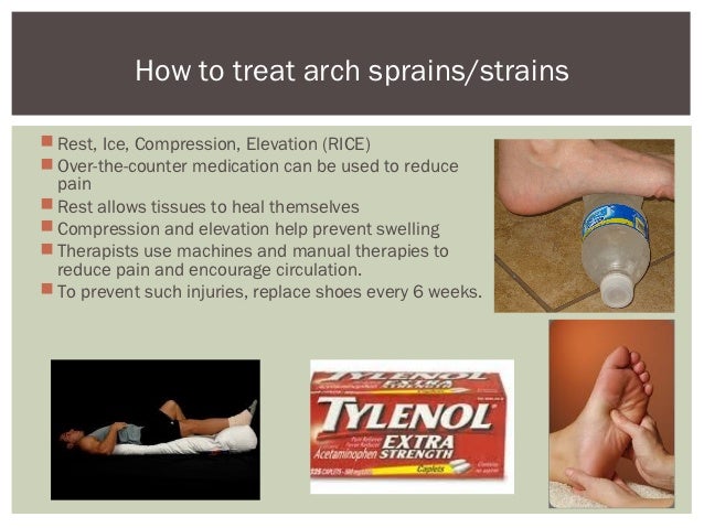 Arch sprains