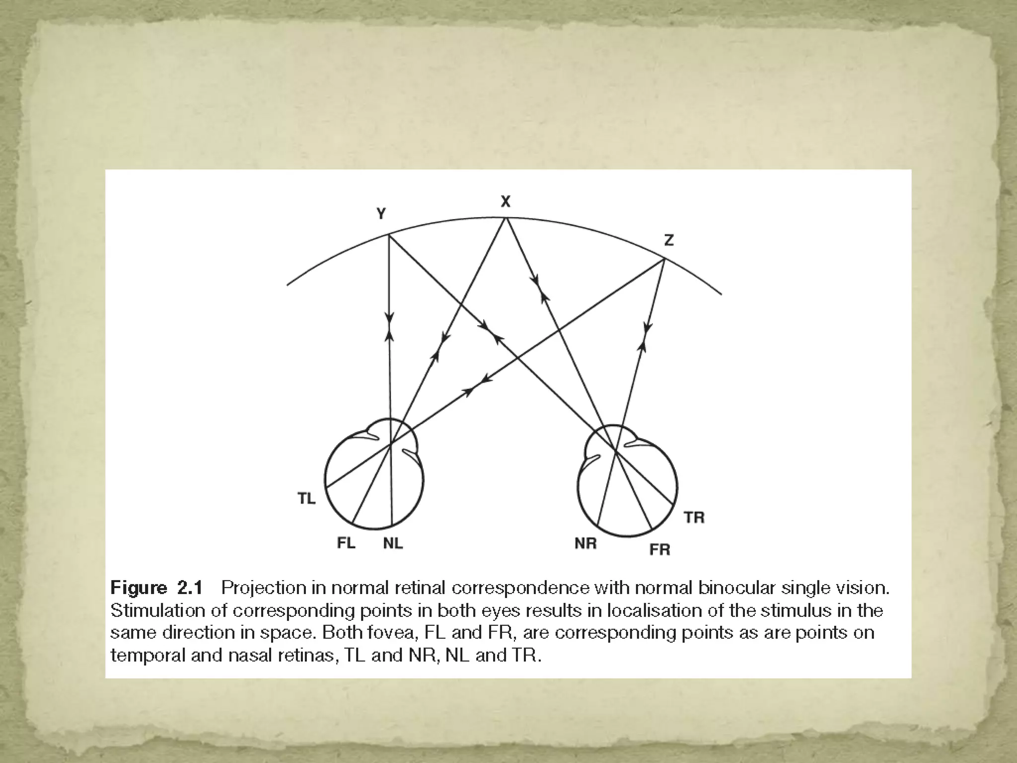 ARC: abnormal retinal correspondence, eccentric fixation | PPTX