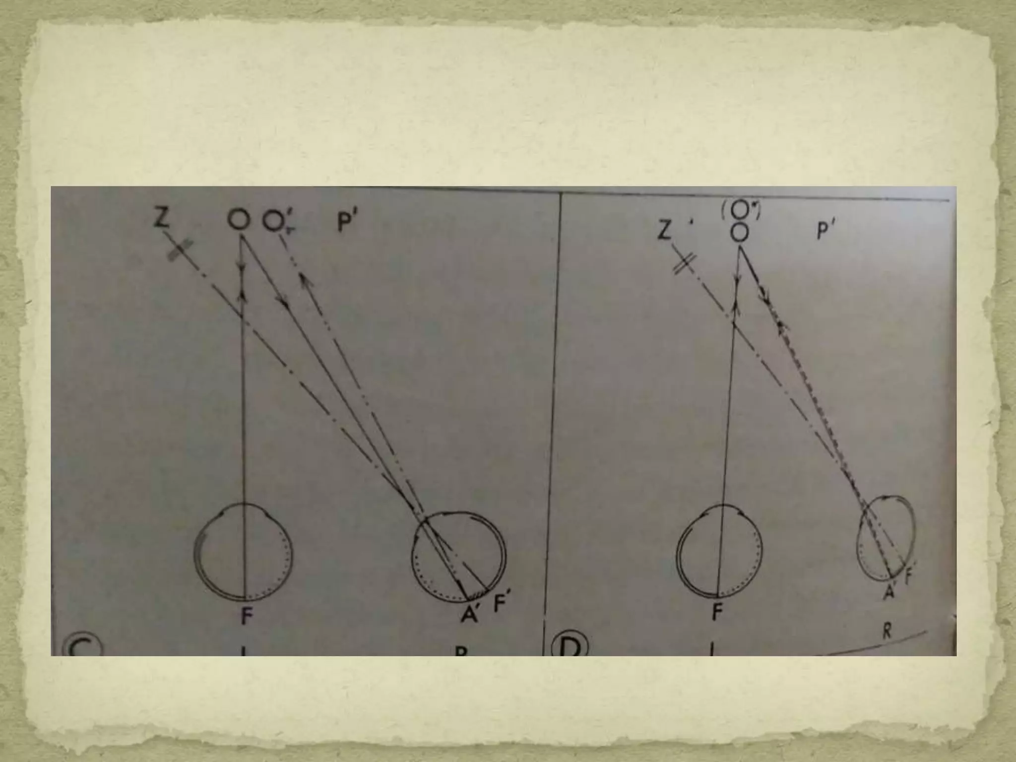 ARC: abnormal retinal correspondence, eccentric fixation | PPTX