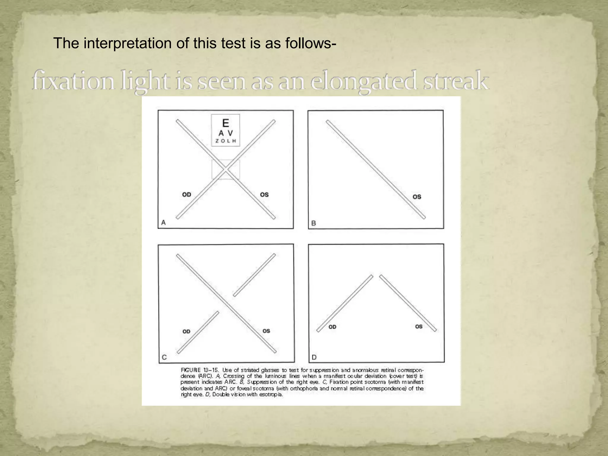 ARC: abnormal retinal correspondence, eccentric fixation | PPTX