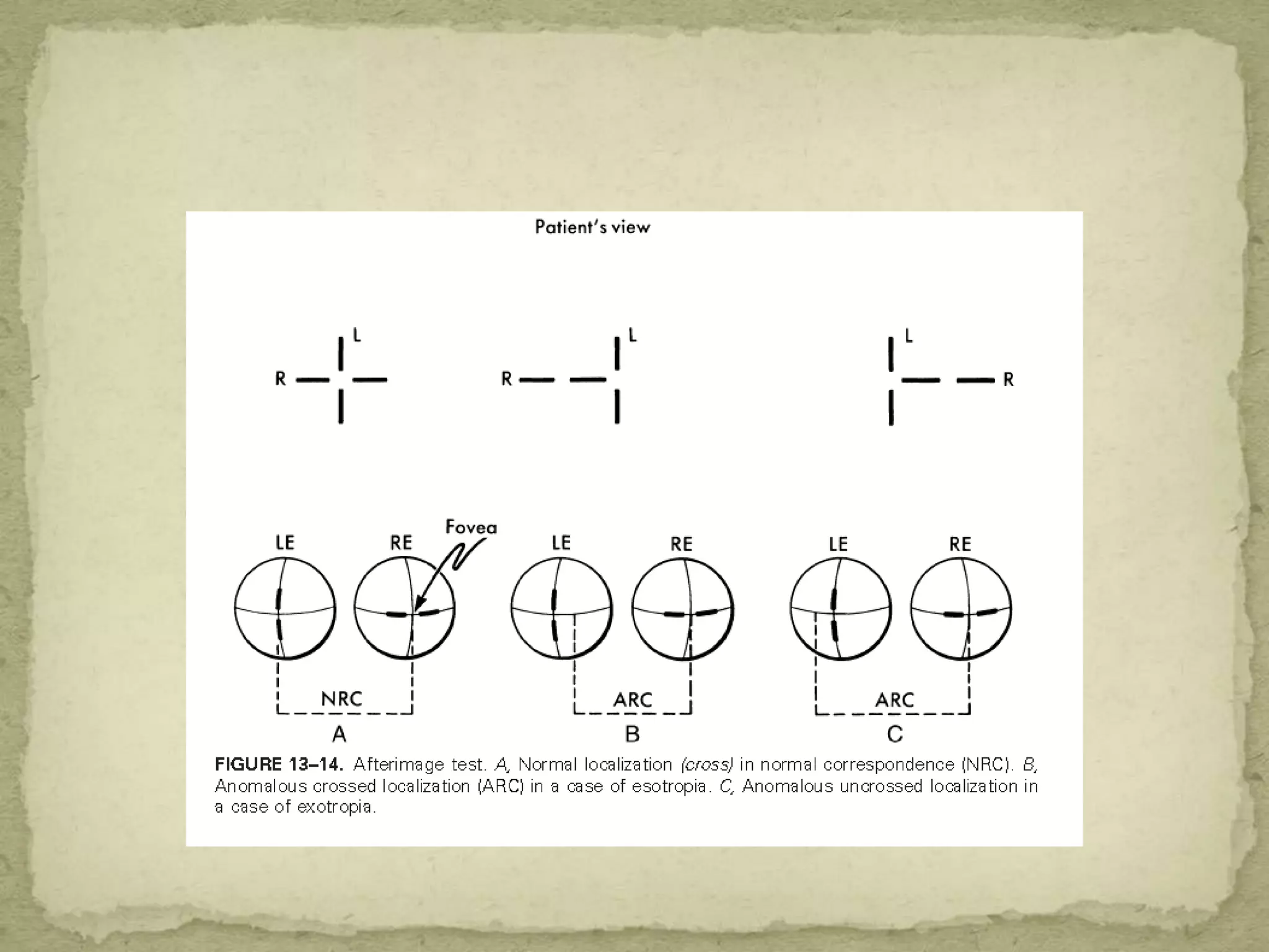 ARC: abnormal retinal correspondence, eccentric fixation | PPTX
