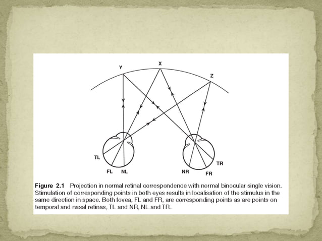 ARC: abnormal retinal correspondence, eccentric fixation