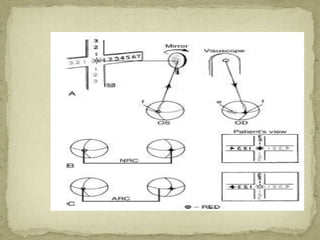 ARC: abnormal retinal correspondence, eccentric fixation | PPT