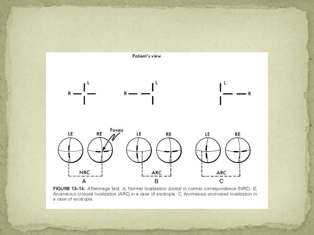 ARC: abnormal retinal correspondence, eccentric fixation