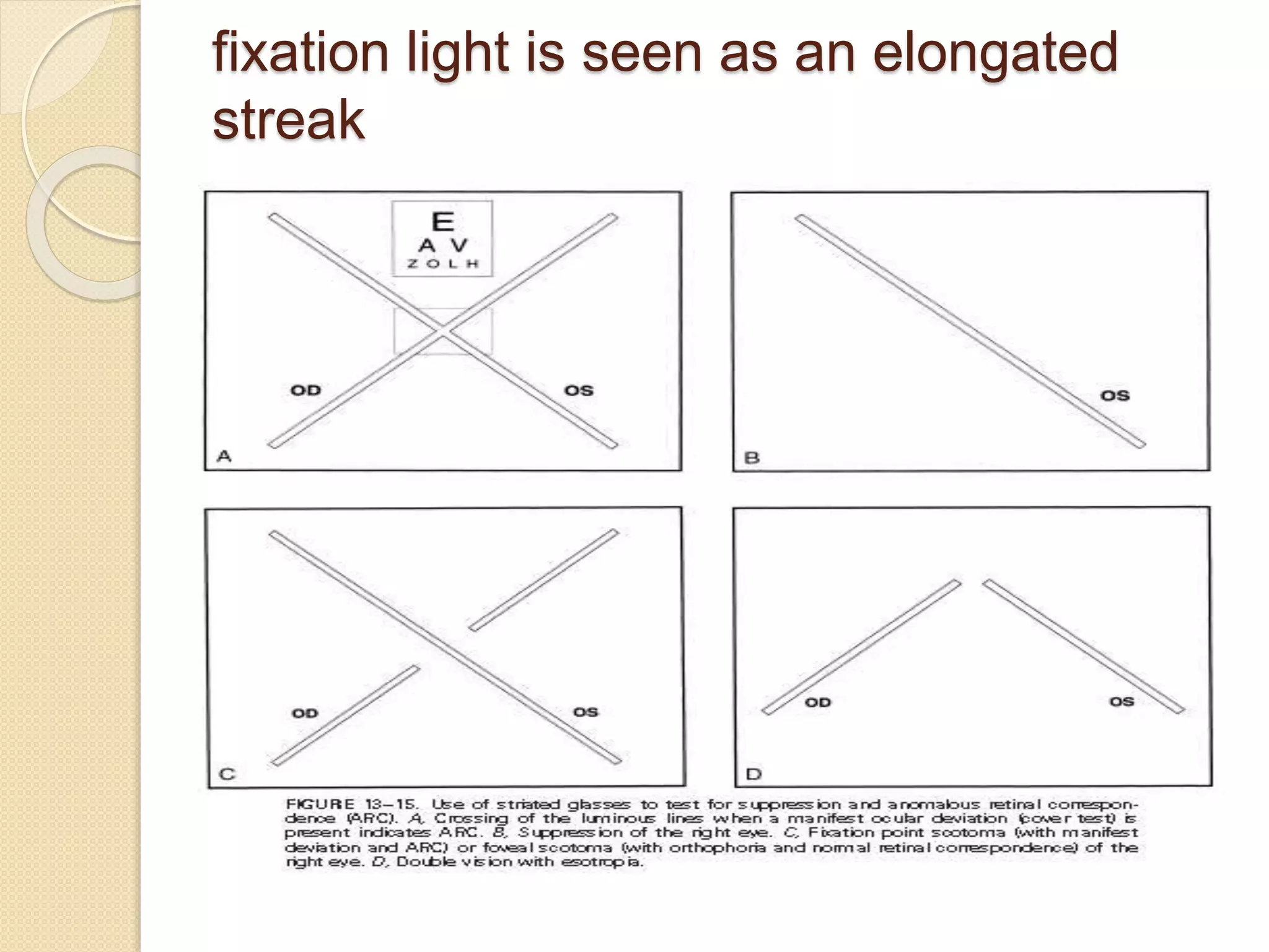 anomalous retinal correspondence | PPTX | Eye and Vision Conditions ...