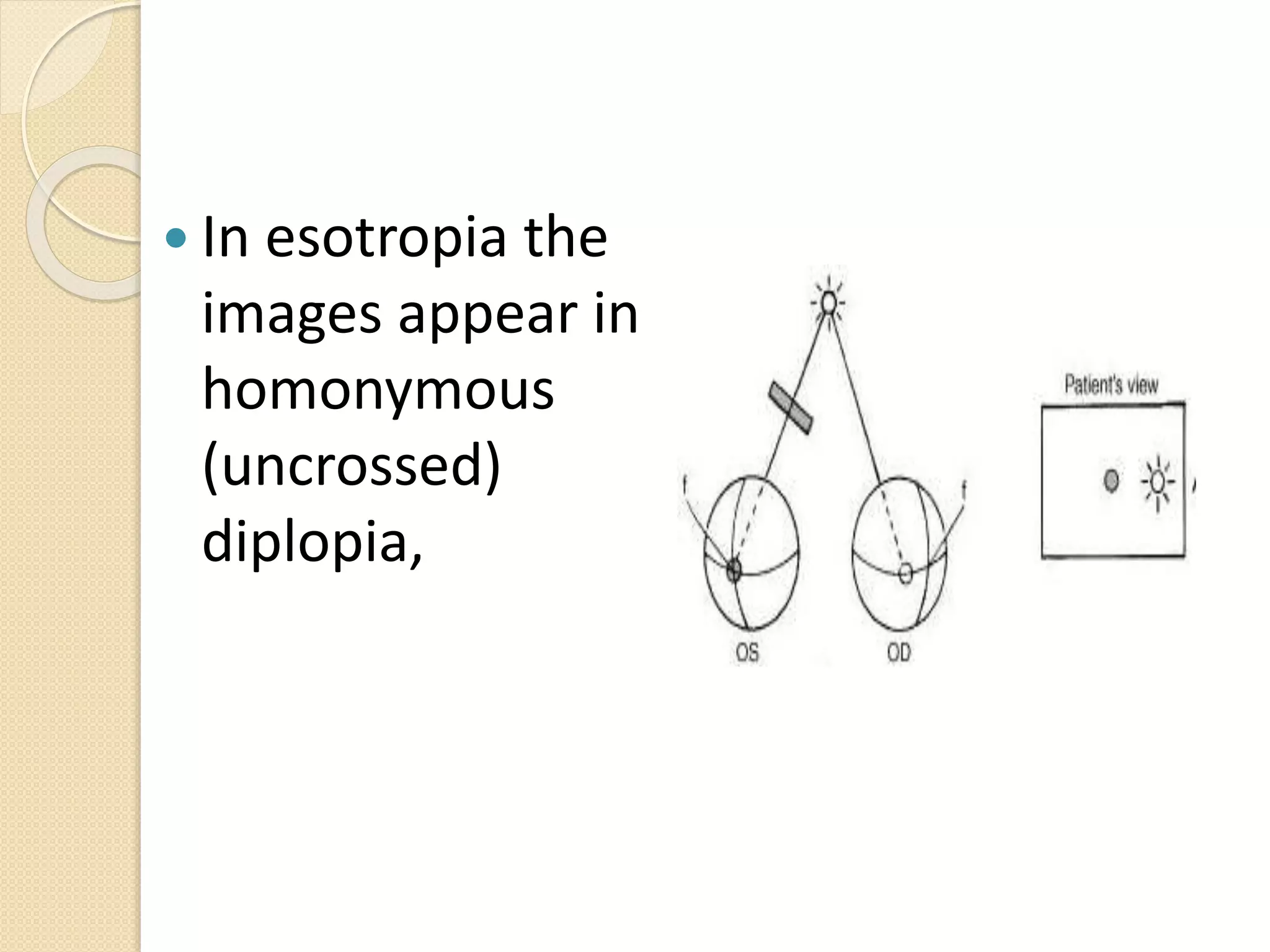 anomalous retinal correspondence | PPTX | Eye and Vision Conditions ...