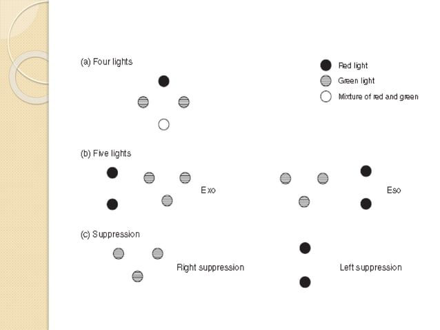 anomalous retinal correspondence | PPTX | Eye and Vision Conditions ...