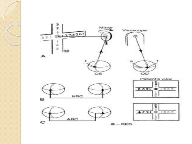 anomalous retinal correspondence | PPTX | Eye and Vision Conditions ...