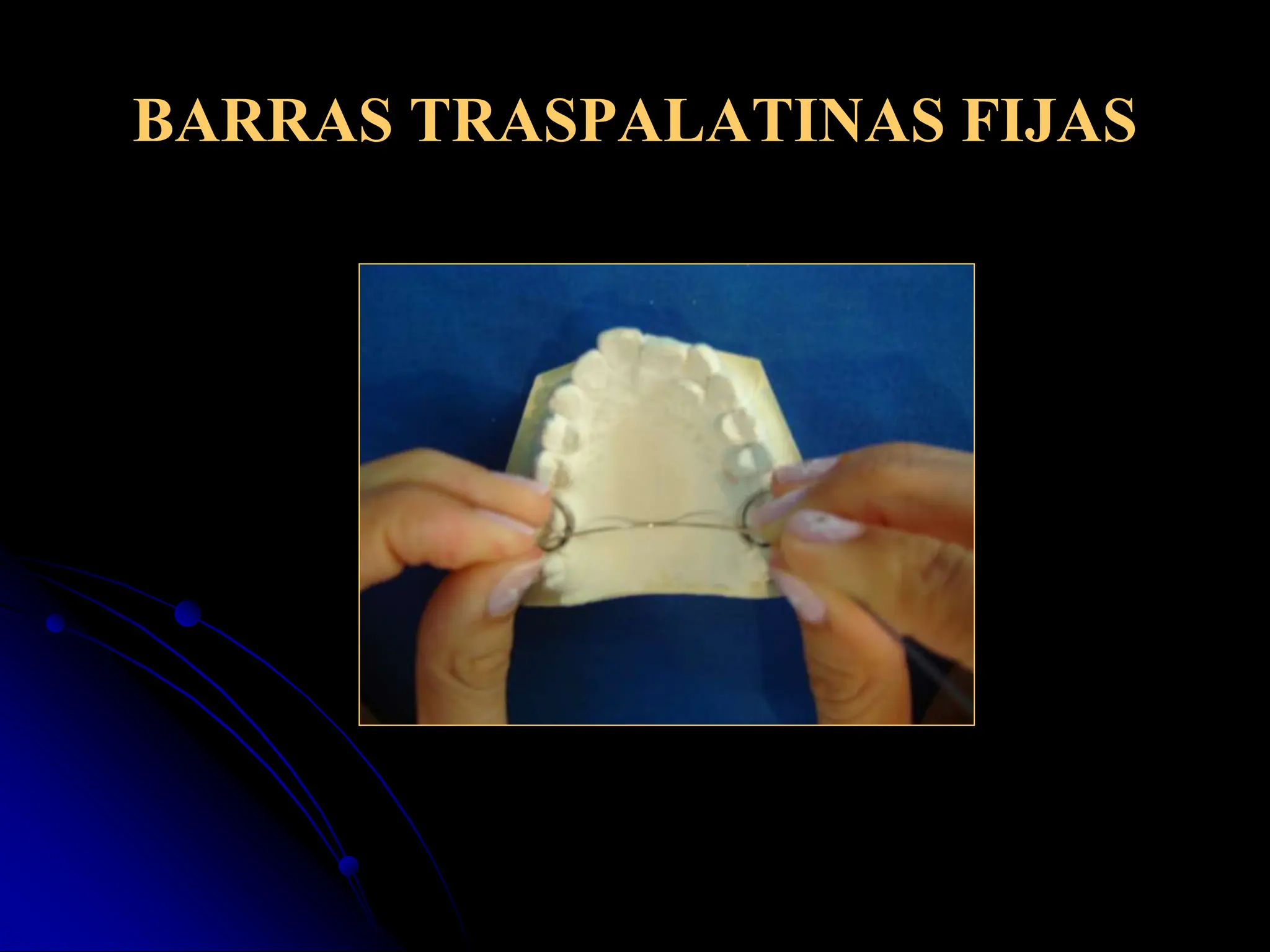 Que es el arco Transpalatino en Ortodoncia | PPT | Dental Health ...