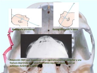 PROYECCIÓN DE ARCO CIGOMÁTICO