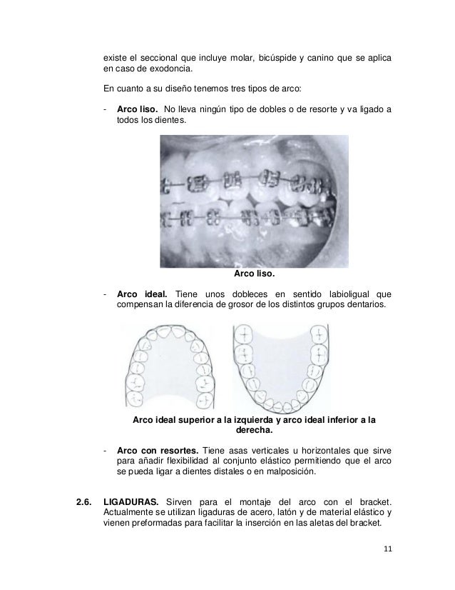 Técnica Arco de Canto - Edgewise - Ortodoncia