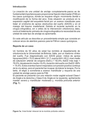 ARCOS DE ALAMBRE PASIVOS PARA FIJACION INTERMAXILAR: UN REPORTE CLINICO ...