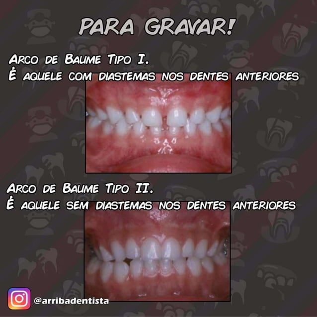 Arco Tipo I e Tipo II de Baume - Resumo Concurso Público de Odontologia.pdf