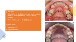 Arco transpalatino y arco lingual | PPTX