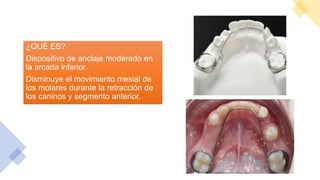 Arco transpalatino y arco lingual | PPTX