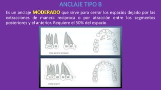 Arco transpalatino y arco lingual | PPTX