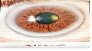 Arcus senilis.pptx