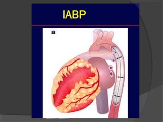 Intra Aortic Balloon Pump Animation
