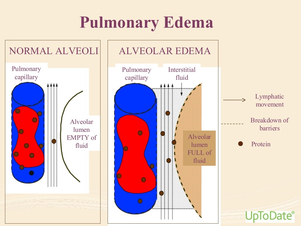 Pediatric Acute Respiratory Distress Syndrome