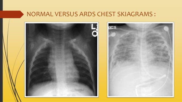 acute respiratory distress syndrome
