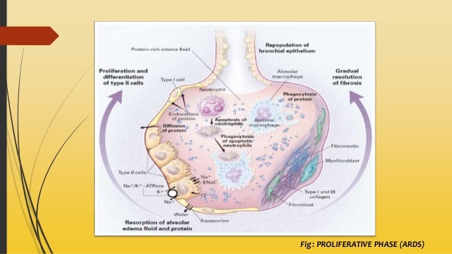 acute respiratory distress syndrome
