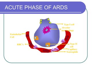 Acute Respiratory Distress Syndrome | PPTX