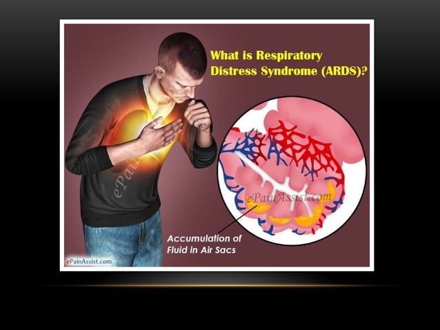ards-190120193647.pptx ards topic presentation | PPT