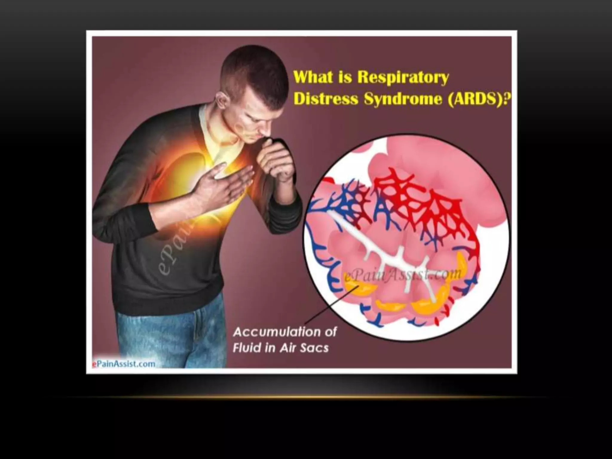 Acute respiratory distress syndrome | PPTX