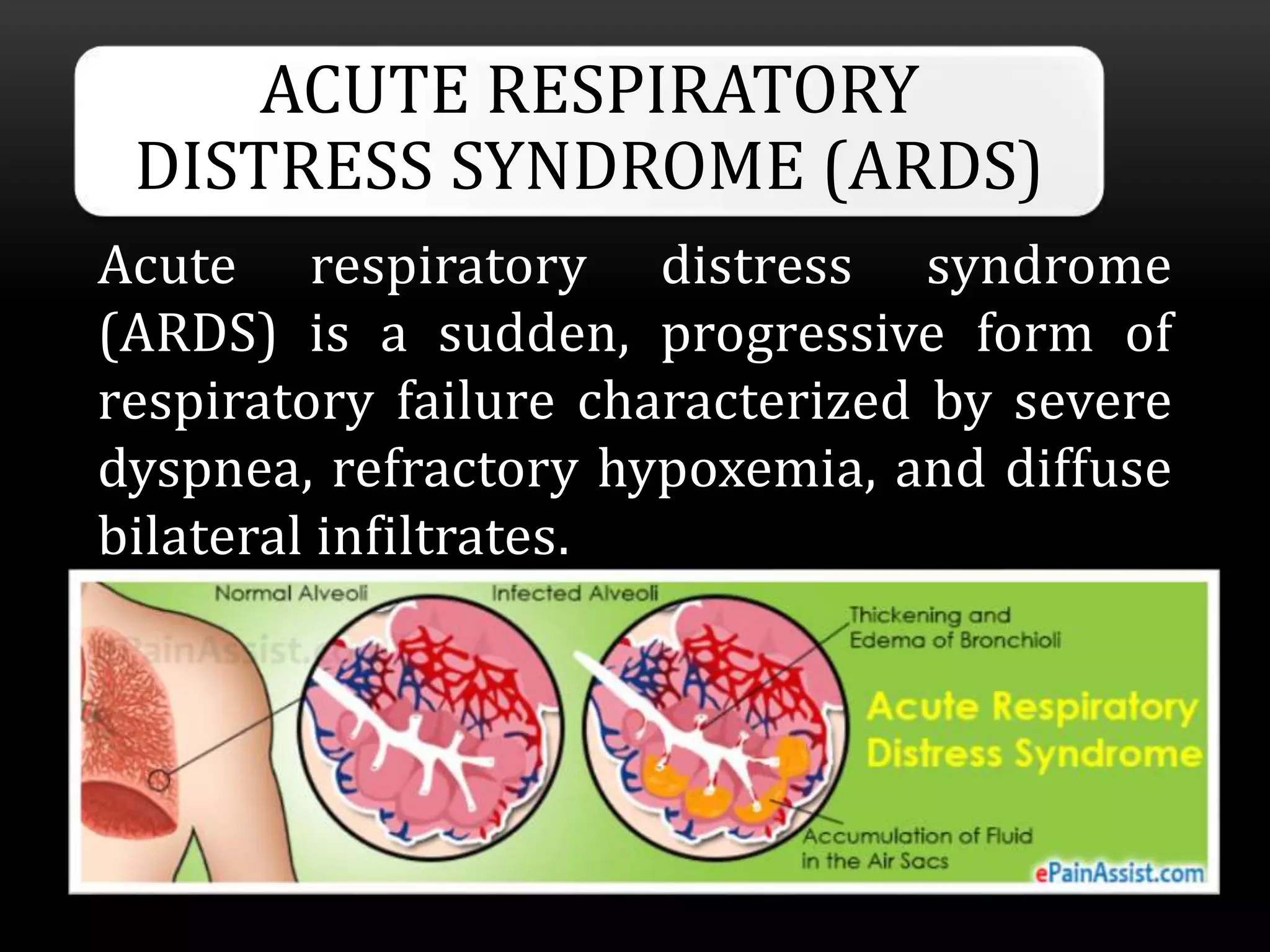 Acute respiratory distress syndrome | PPTX