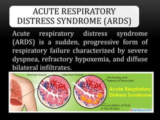 Acute respiratory distress syndrome | PPTX