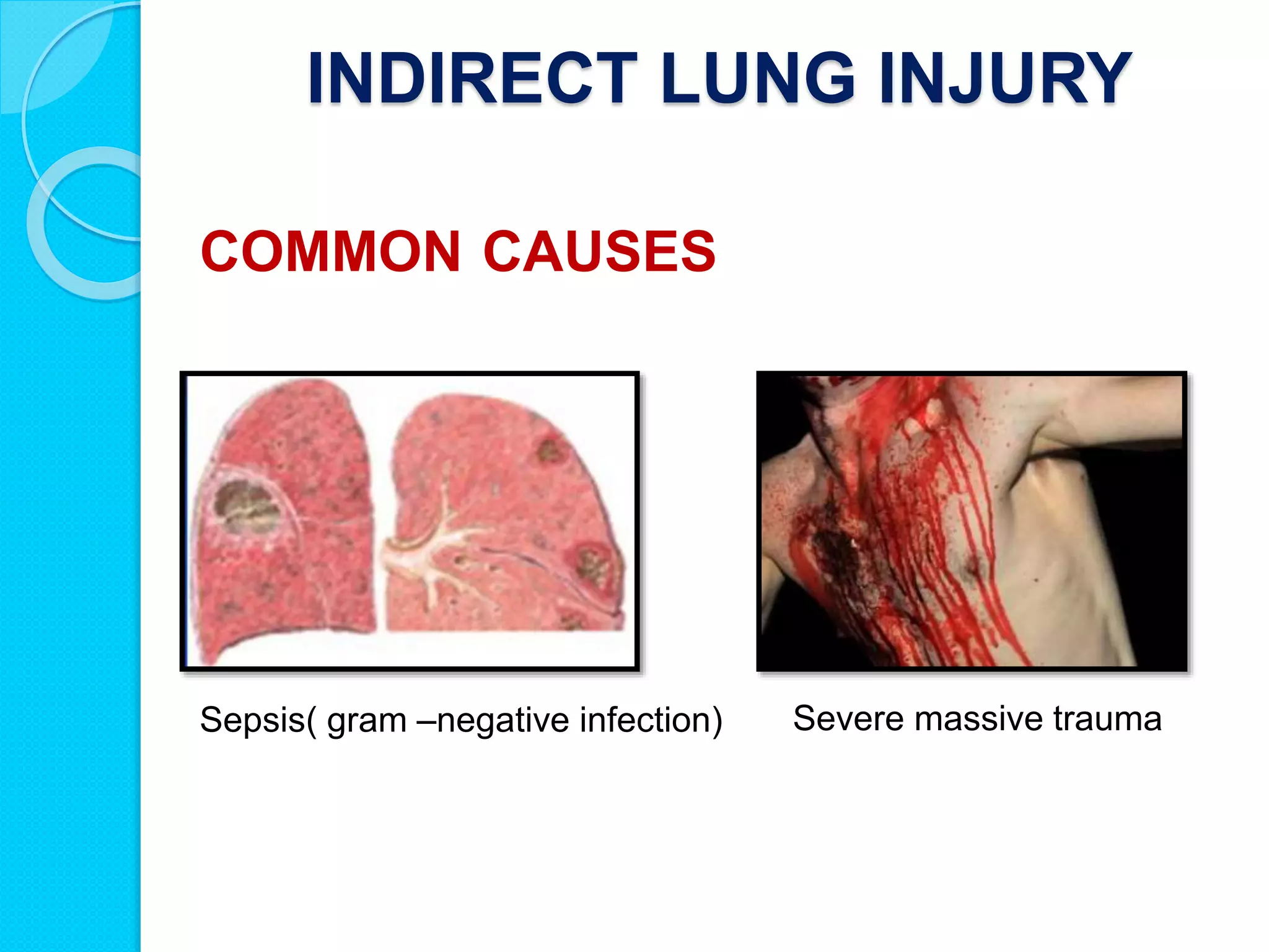 ACUTE RESPIRATORY DYSTRESS SYNDROME | PPTX