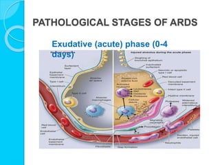 ACUTE RESPIRATORY DYSTRESS SYNDROME | PPT