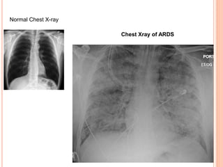 Adult respiratory distress syndrome & nursing care | PPTX