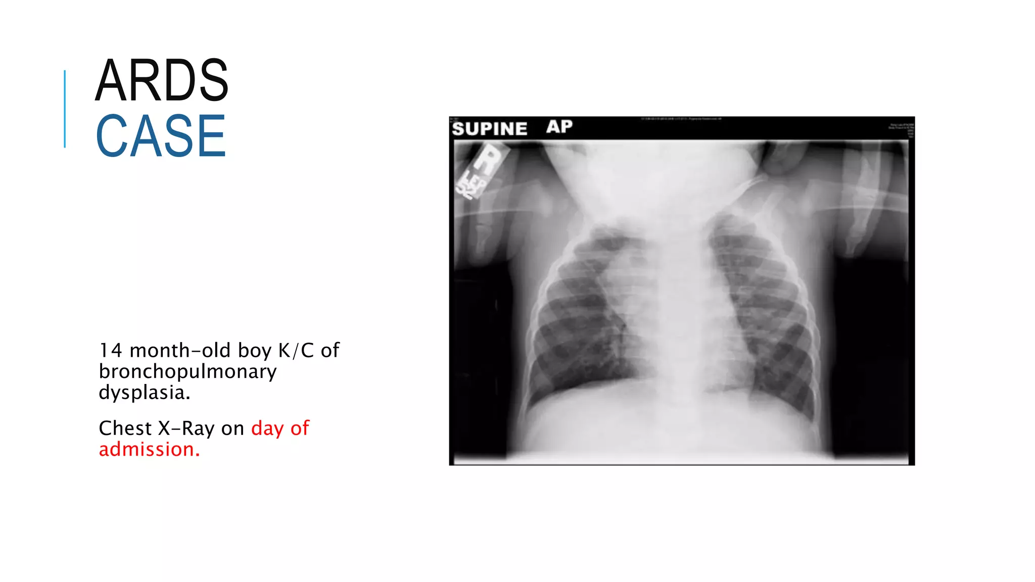 pediatric Acute Respiratory Distress Syndrome ( ARDS ) | PPTX