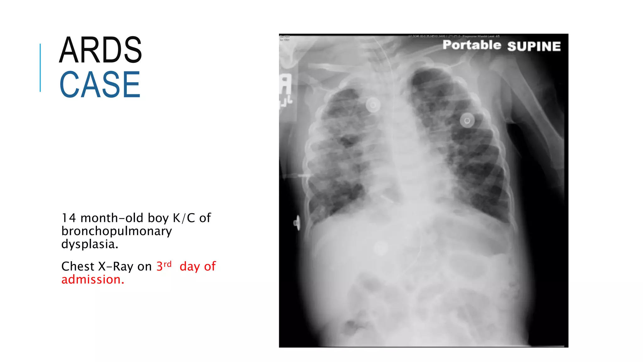 pediatric Acute Respiratory Distress Syndrome ( ARDS ) | PPTX