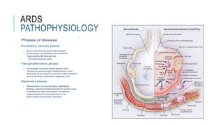 pediatric Acute Respiratory Distress Syndrome ( ARDS ) | PPTX