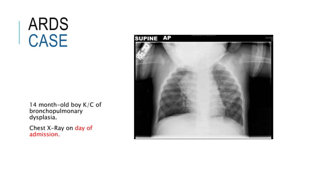 pediatric Acute Respiratory Distress Syndrome ( ARDS ) | PPTX