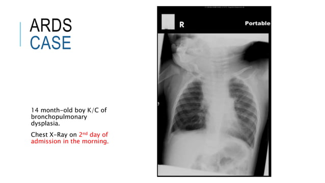 pediatric Acute Respiratory Distress Syndrome ( ARDS ) | PPTX