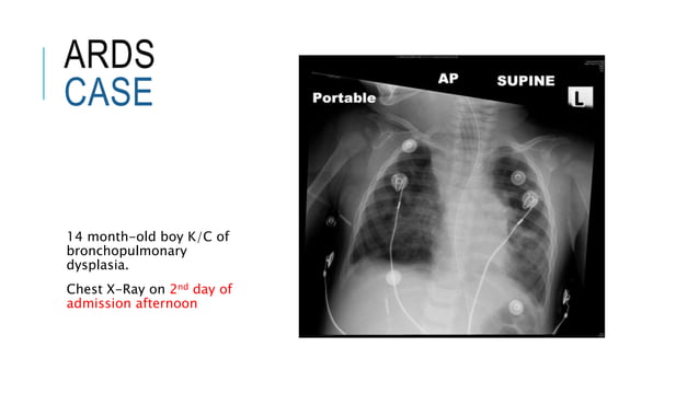 pediatric Acute Respiratory Distress Syndrome ( ARDS ) | PPTX