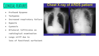 ARDS ( Acute Respiratory Distress Syndrome ) | PDF