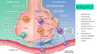 ARDS ( Acute Respiratory Distress Syndrome ) | PDF