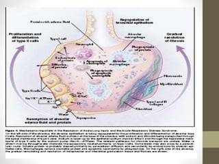 ARDS.pdf