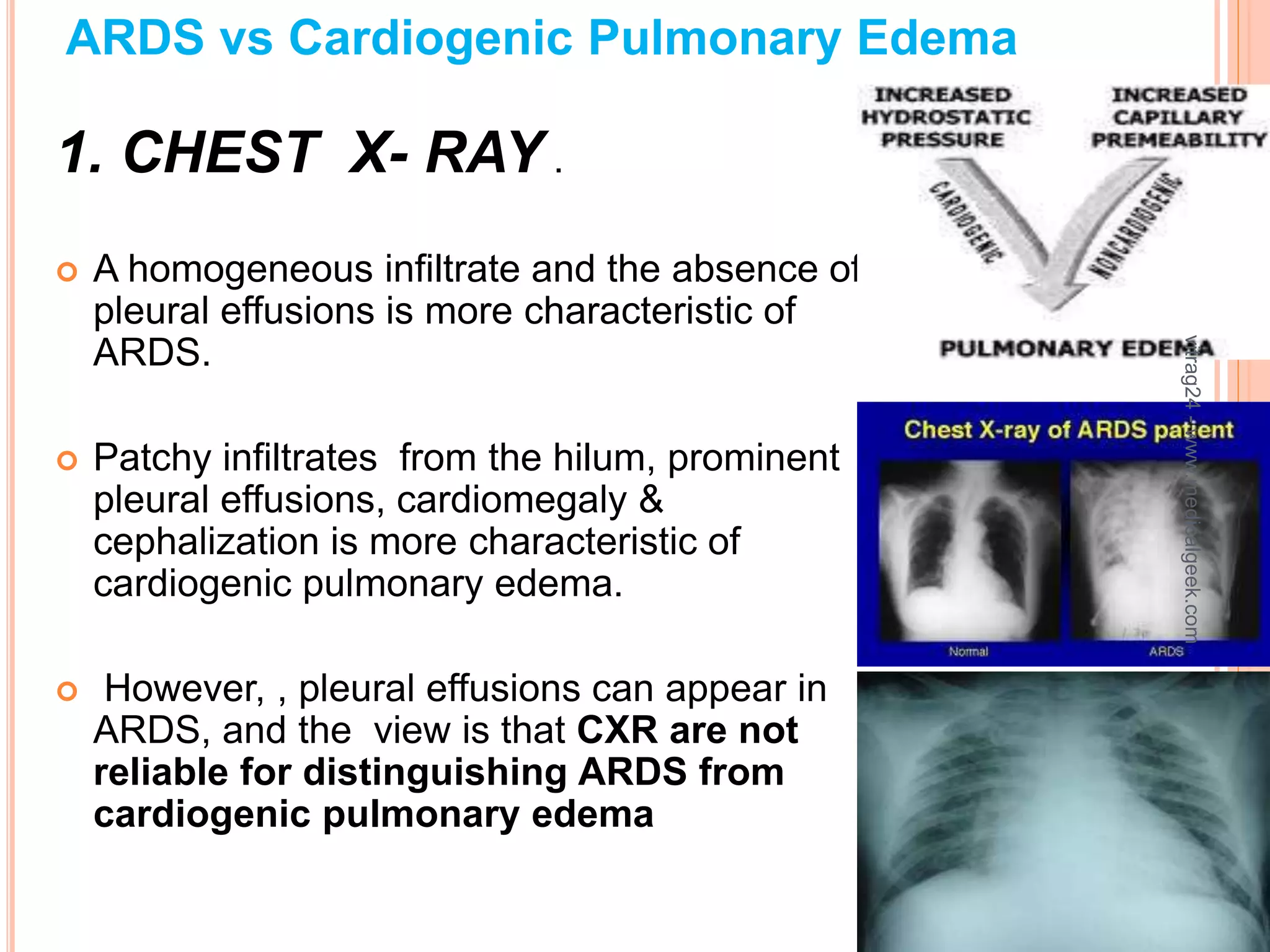 ARDS - Diagnosis and Management | PPTX