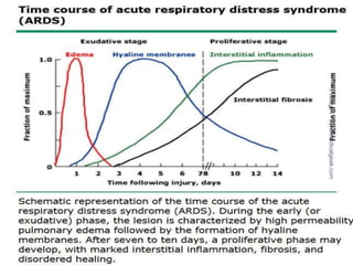 ARDS - Diagnosis and Management | PPTX
