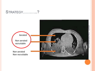 ARDS - Diagnosis and Management | PPTX