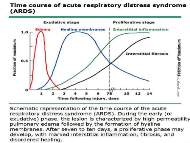 ARDS - Diagnosis and Management