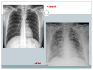 ARDS | PPT